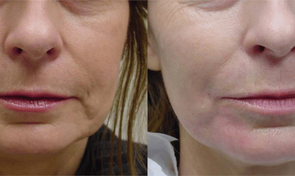 Nose to Mouth Lines - Maryland Dermatology Laser, Skin & Vein Institute