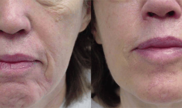 Nose to Mouth Lines - Maryland Dermatology Laser, Skin & Vein Institute